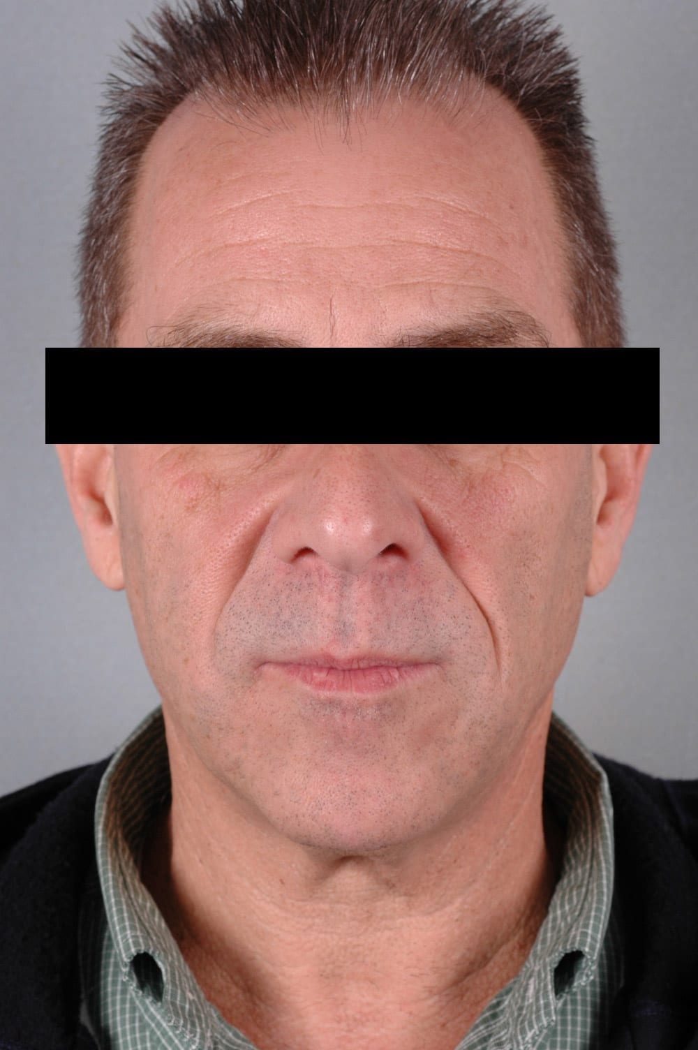 Before & After Injectables Photos | Spring Ridge Plastic Surgery