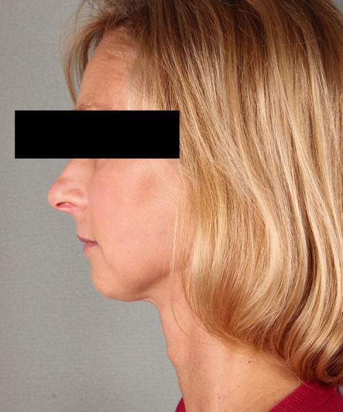 Before & After Precision Tx 03 Photos | Spring Ridge Plastic Surgery