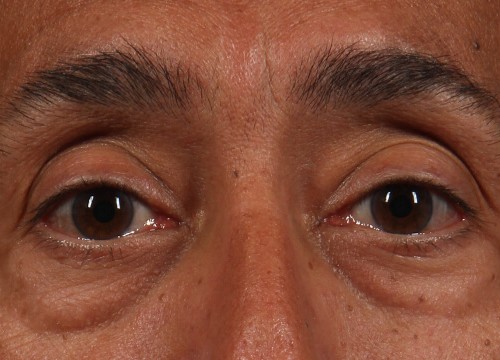 Before & After Eyelid Surgery 09 Photos | Spring Ridge Plastic Surgery